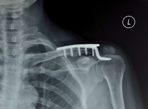 Shoulder Fusion Lawyer - Missouri Workers’ Compensation Benefits