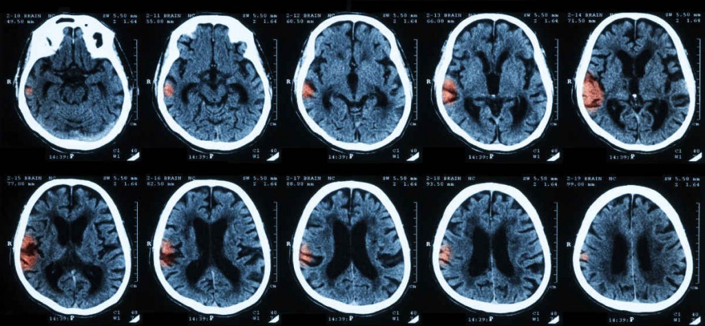 St. Louis Workers Compensation Attorney: Intracranial Injury and Work Comp